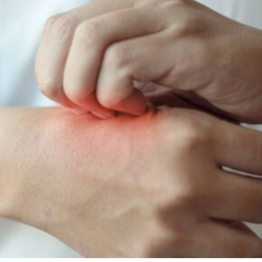 How to Identify and Treat Common Skin Issues Caused by Bras - No.1 Eco ...